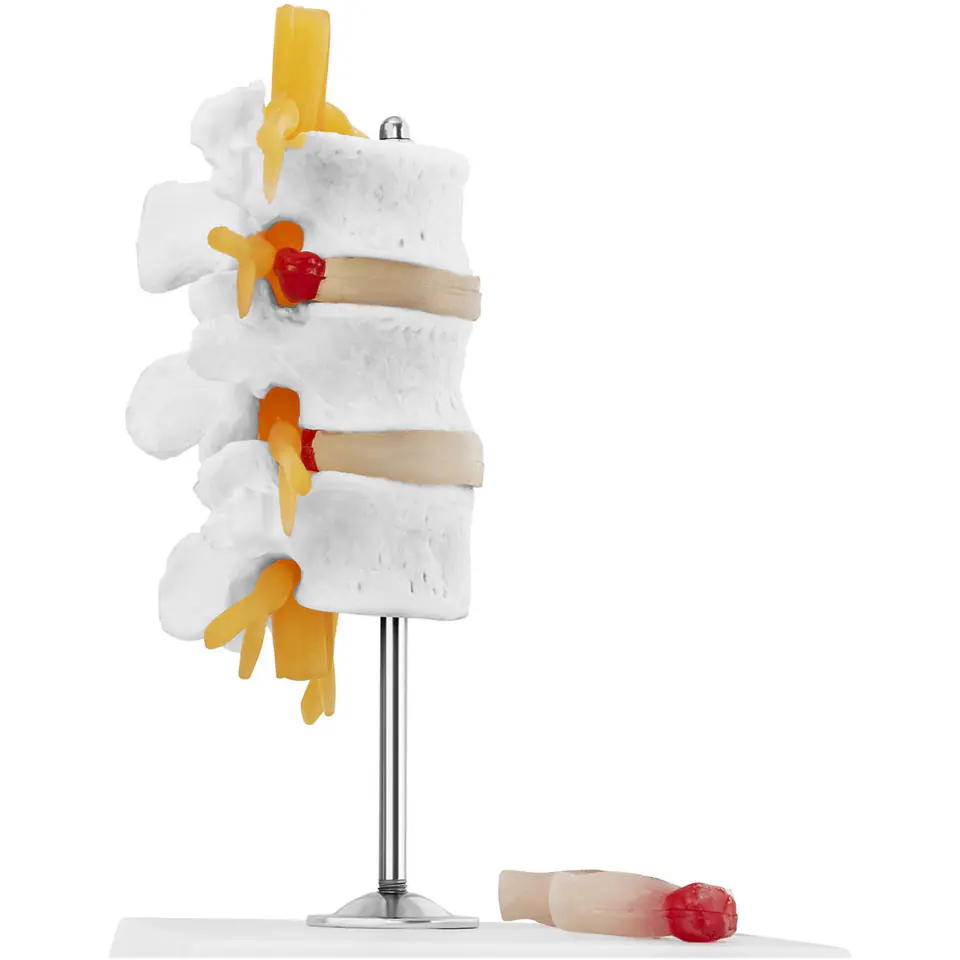 3D anatomical model of lumbar spine with hernia, vertebrae 3-5 ...