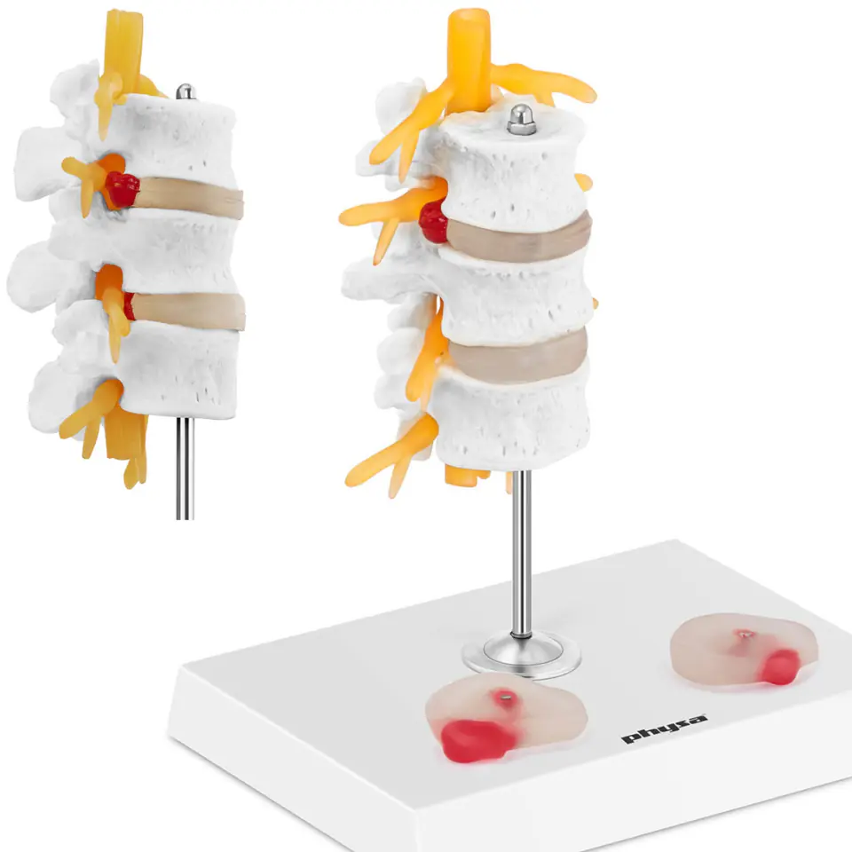 3D anatomical model of lumbar spine with hernia, vertebrae 3-5 ...